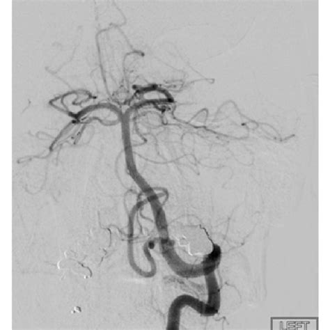 Ct Angiography A And A 4 Vessel Cerebral Arteriogram B Showed No