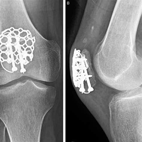 Robinsons Classification System For Midshaft Clavicular Fractures Download Scientific Diagram