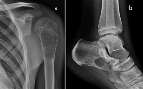 Les Kystes Osseux Orthopedie Pediatrique Com