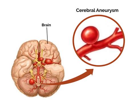 Cerebral Aneurysm Treatians