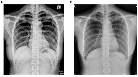 Pneumothorax Treatment