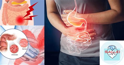 Sindrome Del Intestino Irritable Sii Causas Y Sintomas