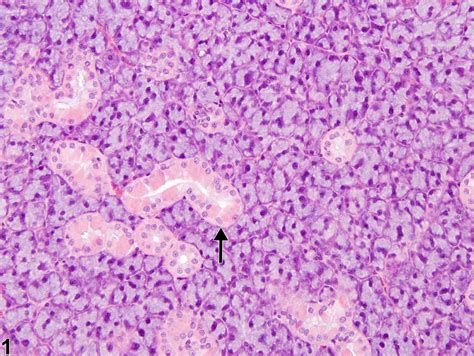 Submandibular Gland Tumor Histology