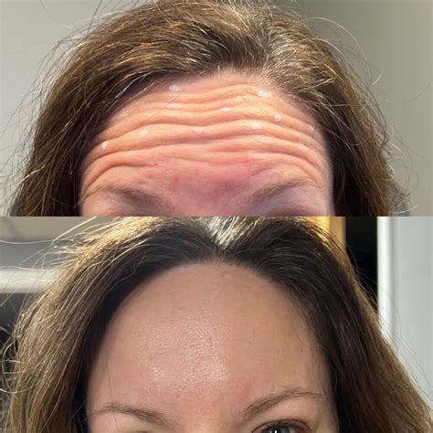 Botox In Canal Winchester Oh Mobo Medical Spa