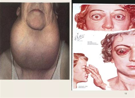 Drugs Used In Hyperthyroidism Ppt