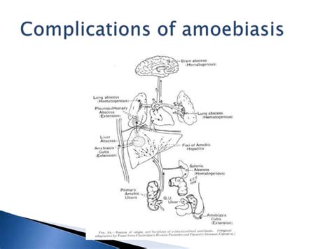 Amoebiasis Pathogenesis And Pathology Pptx Digestive Disorders