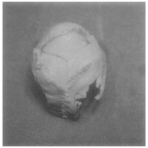 Postoperative View Of The Explanted Xenograft In Patient 2 Distortion