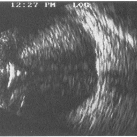 B Scan Ultrasonography Of The Left Eye Showing Large Kissing Choroidals Download Scientific