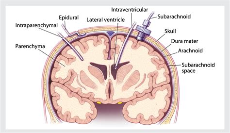 Types Of Icp Monitoring Devices At Angus Daplyn Blog
