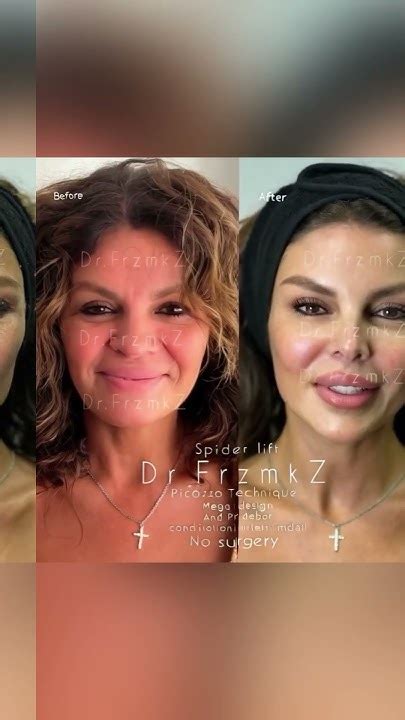 Picasso Technique 🇺🇸 Drfrzmkz Drfarzan Malekzadehp1 Device And Conditionmedia And Ctsf