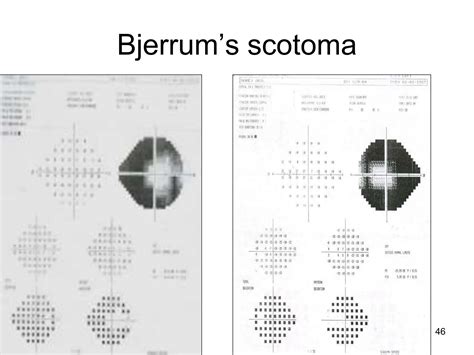 Primary Open Angle Glaucoma Presentation Ppt