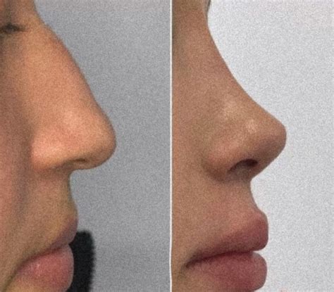 Pixie Nose Cirujia De Nariz Cirugia Plastica De Nariz Cirugias De Nariz