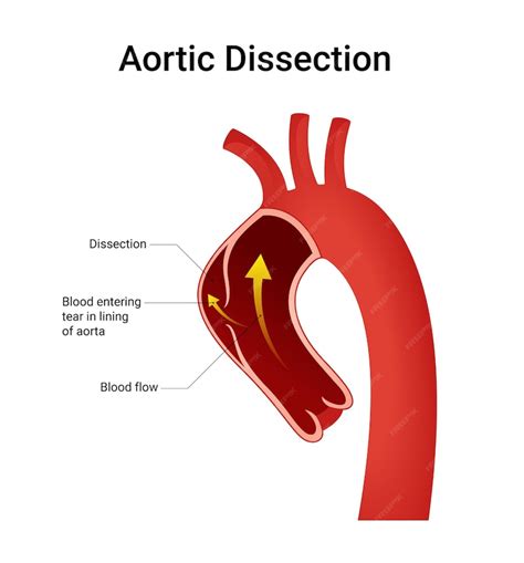 Premium Vector Schematic Diagram Of Aortic Dissection