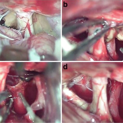 Intraoperative Video Captured Photographs A Before Tumor Resection Download High