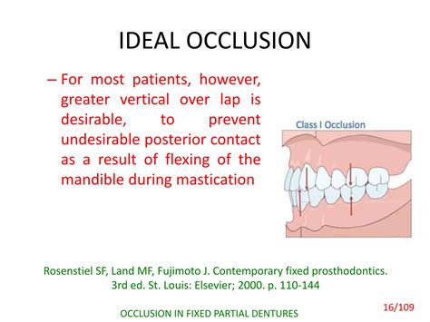 Occlusion In Fixed Partial Denture Pptx Occlusion In Fixed Partial Denture Pptx