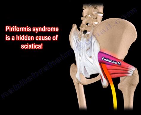Piriformis Syndrome And Sciatica —