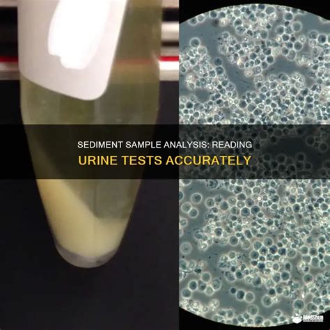 Sediment Sample Analysis Reading Urine Tests Accurately Medshun