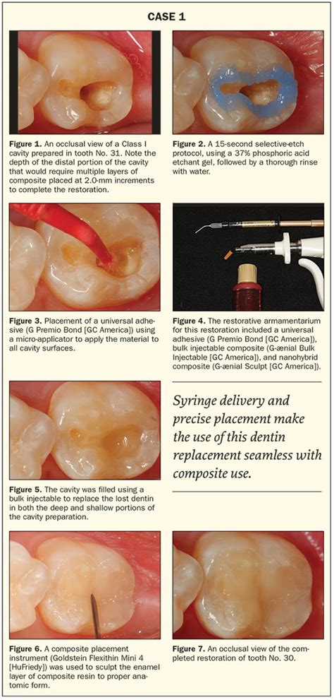 Material Options For Class Ii Composite Restorations Varied Clinical Parameters Require