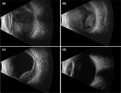 Suprachoroidal Hemorrhage Associated With Cataract Surgery A Case