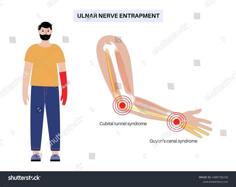 Ulnar Nerve Entrapment Cubital Tunnel Syndrome Stock Vector Royalty