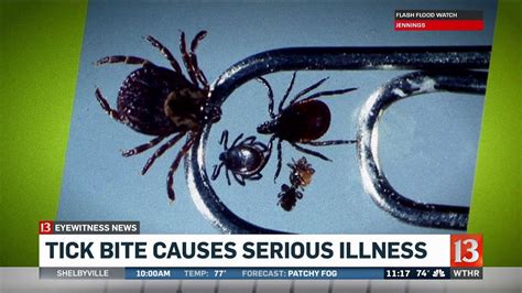 Tick Bites Can Cause Serious Illness Youtube