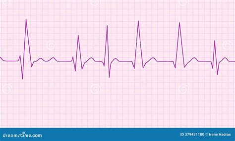 Electrocardiogram Ecg Trace On Pink Graph Paper Displays A Sequence