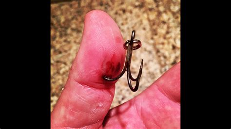 How To Remove Barbed Hook From Skin At Steven Waddy Blog