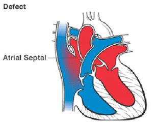 Surgery For Atrial Septal Defect Cphbou