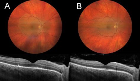Acute Syphilitic Posterior Placoid Chorioretinitis A Is Represented
