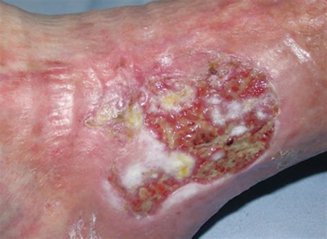 Epithelial Tissue Wound Tissue Types In Wound Bed