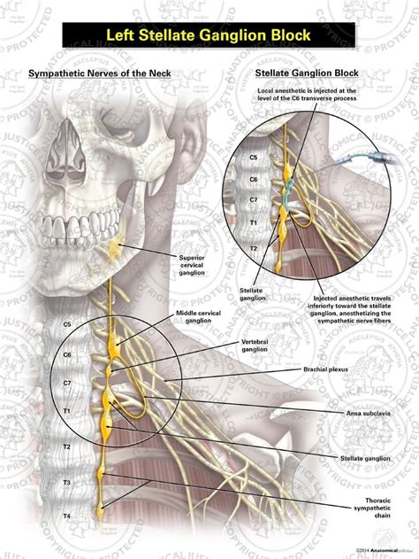 Male Left Stellate Ganglion Block