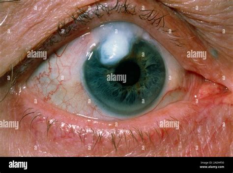 Eye Bleb Eye Of An Elderly Patient With A Bleb Above The Iris An Eye Bleb Is An Elevation Of