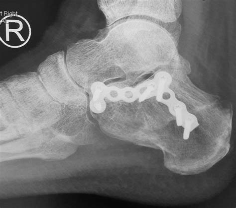 Anterior Calcaneus Fracture
