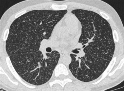 Approaching Multinodular Lung Disease Starts By Placing The Nodules Into One Of Three
