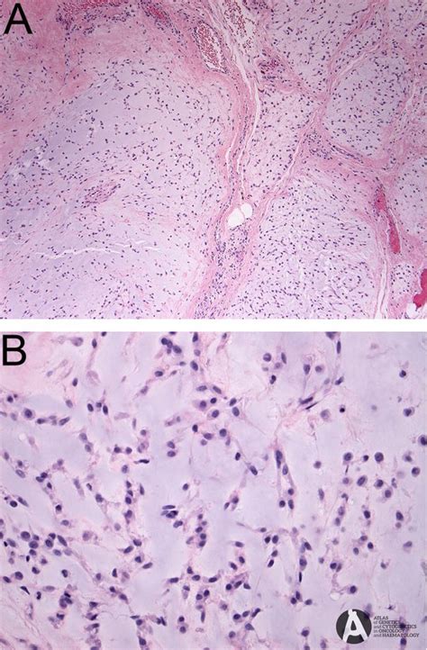 Soft Tissues Extraskeletal Myxoid Chondrosarcoma