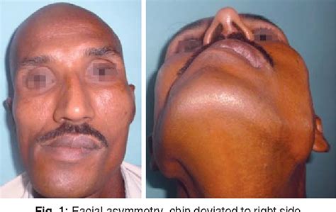 Figure 1 From Condylar Hyperplasia Semantic Scholar