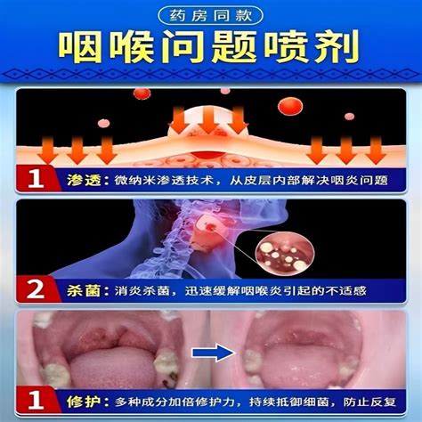 治疗咽炎慢性咽炎，这款喷雾真的能除根？🔥深度测评 淘宝好物网