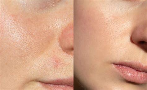 Exosome Treatment For Skin Rejuvenation Monaz Clinic London