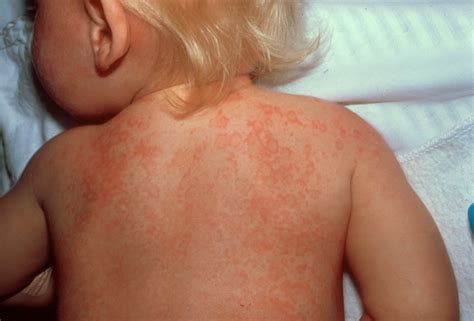 Kawasaki Disease Causes Signs Symptomstreatment