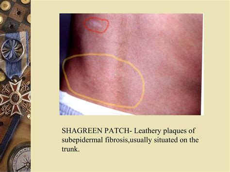 Neuro Cutaneous Markers Ppt