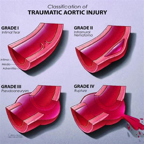 Traumatic Aortic Injury Classification 24 Reprinted From J Vasc