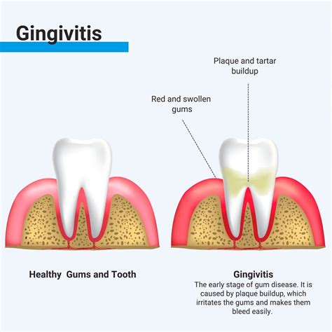 Periodontal Gum Treatment Franklin Square Ny Nassau County Gingivitis Treatment