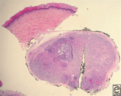 Low Power Image Showing A Well Circumscribed Encapsulated Tumor In