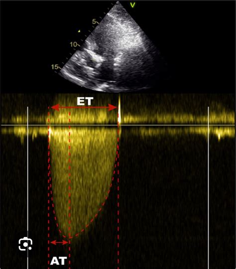 Why Ejection Time Matters In Aortic Stenosis When We Assess Severe Aortic Stenosis As Our