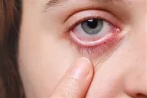 Tips To Prevent Conjunctivitis