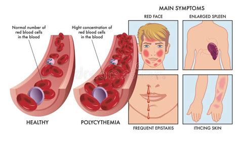 Human Polycythemia Stock Illustrations 20 Human Polycythemia Stock