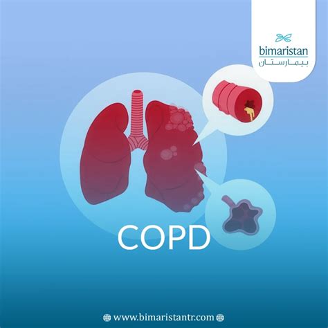 Does Lifestyle Impact Preventing Copd Progression You Should Know About Holistic Solutions For