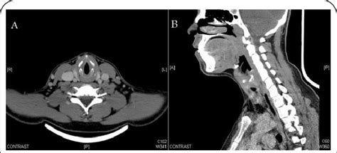 Computed Tomography Of Second Patient Showing A Axial And B