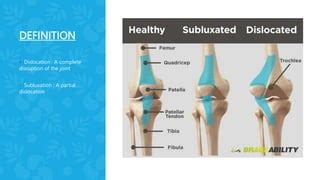 Hip Shoulder And Elbow Dislocationpptx