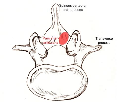 Posterior Neural Arch Fracture